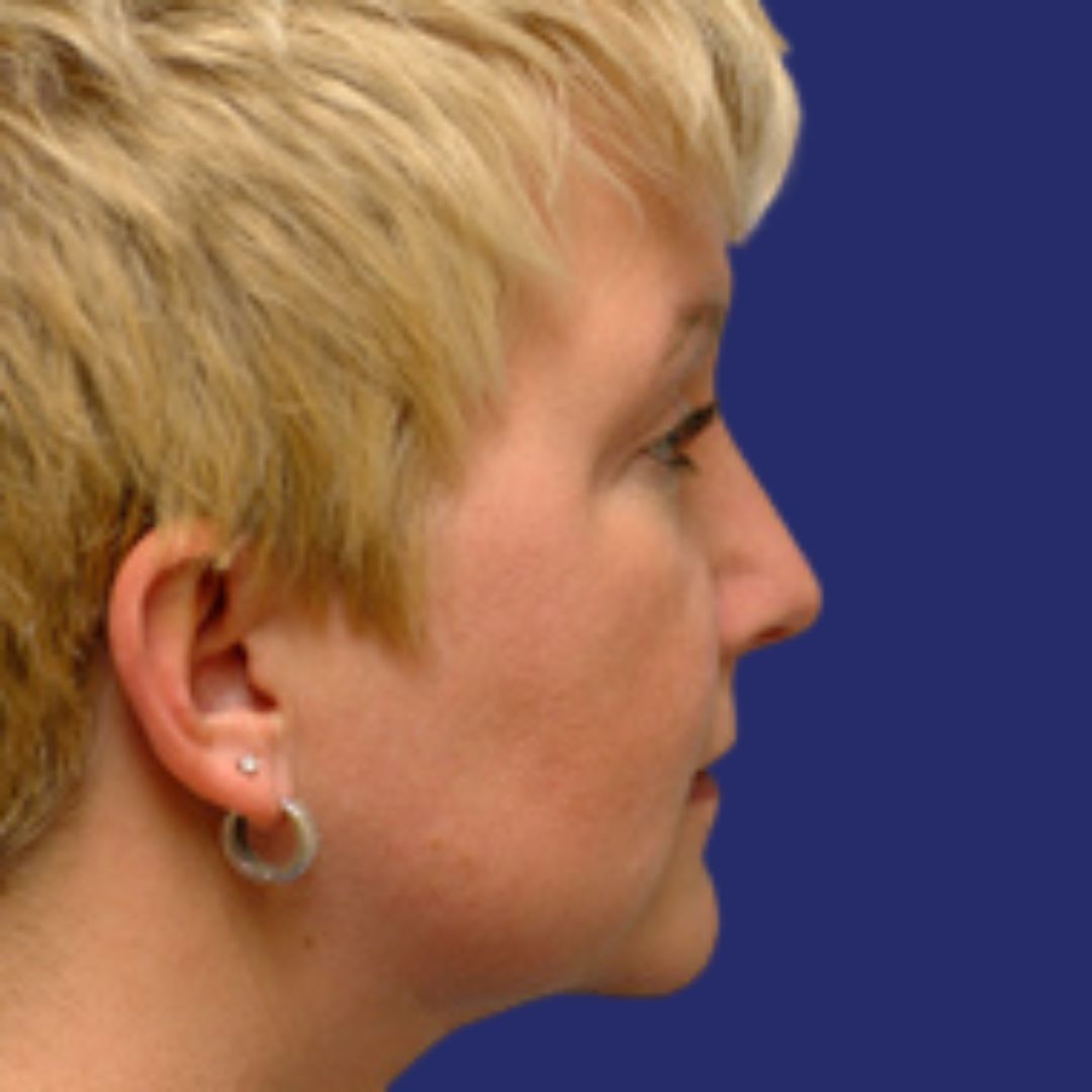 Chin liposuction photos before and after - Wellness Kliniek